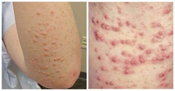 7 Diabetes Skin Problems and Warning Signs You Should Know